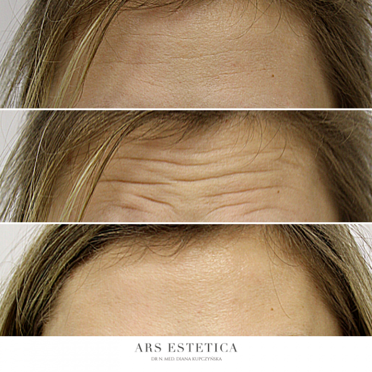 Botoks (botox, toksyna botulinowa) Wrocław / Warszawa | Ars Estetica