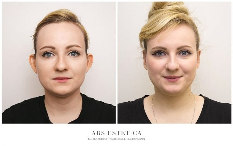 Operacja uszu - cena, efekty, rekonwalescencja | Ars Estetica