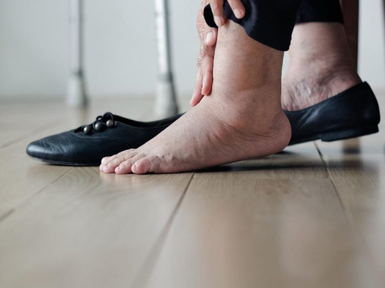 Obrzęki nóg (opuchlizna nóg) - dlaczego nogi puchną? | Ars Estetica Obrzęki nóg (opuchlizna nóg) - dlaczego nogi puchną? | Ars Estetica