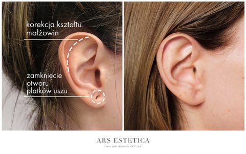 Rekonstrukcja płatka ucha Wrocław | Ars Estetica