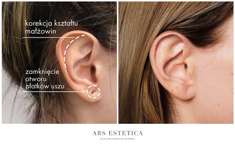 Operacja uszu (korekcja uszu) Wrocław / Warszawa | Ars Estetica